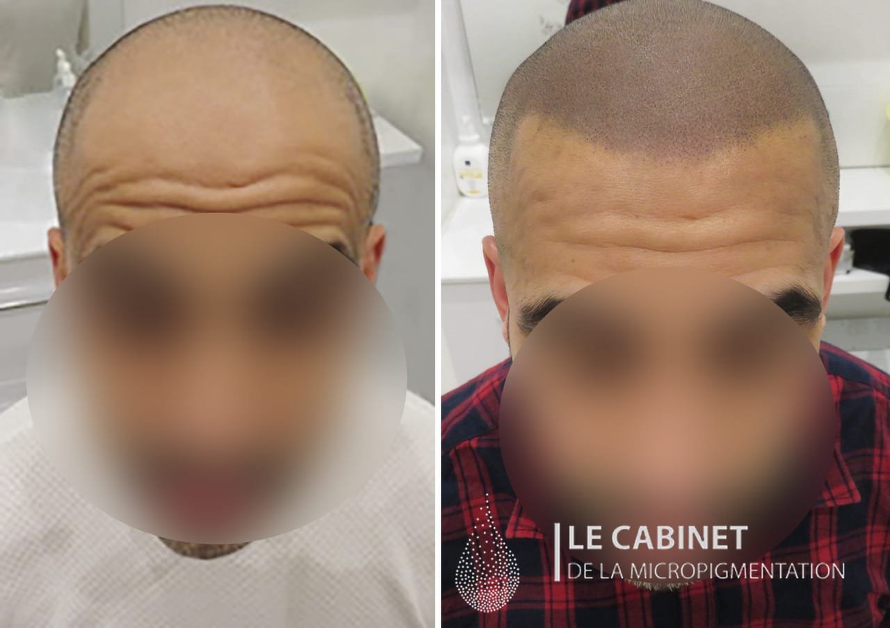 Micropigmentation capillaire : les transformations physiques