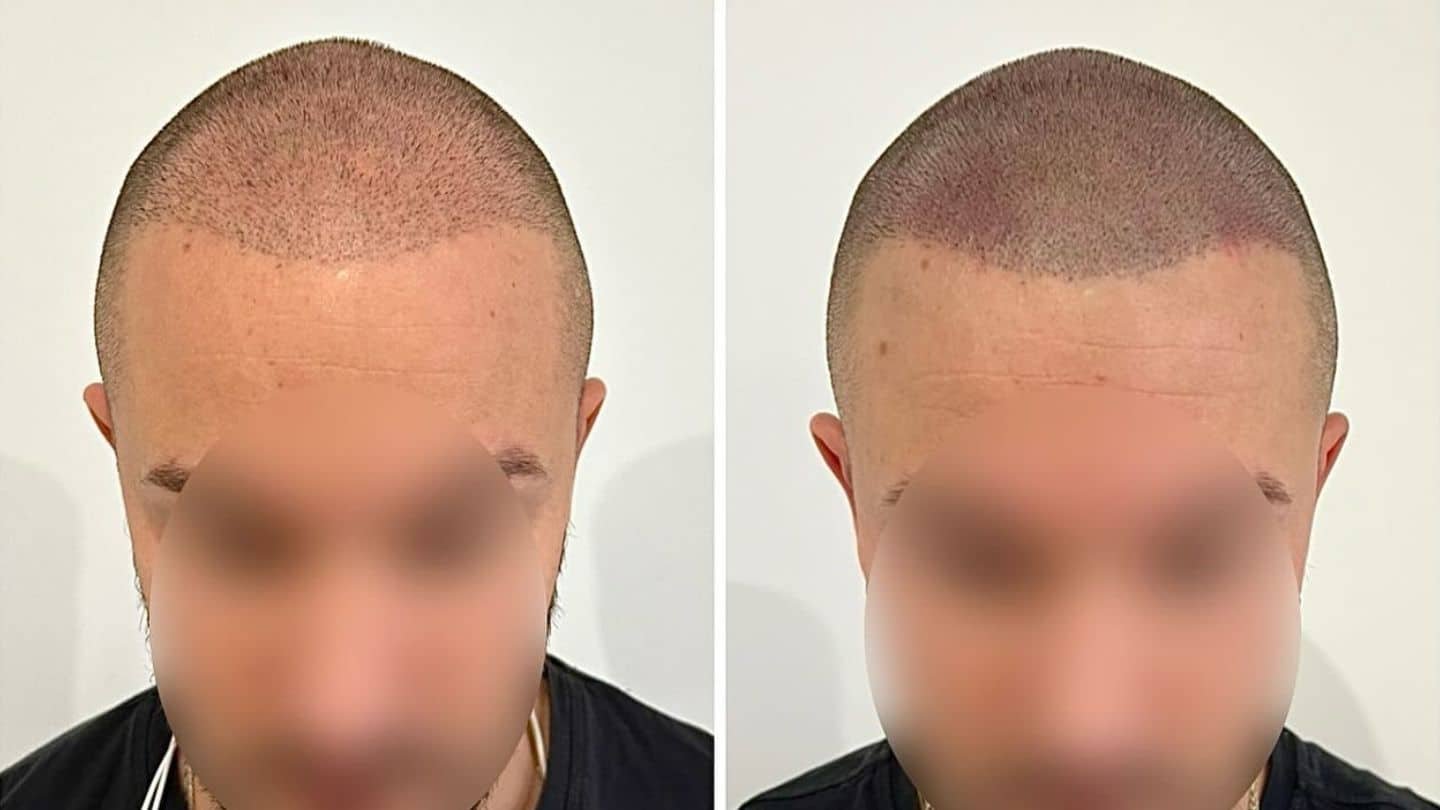 Micropigmentation capillaire : les transformations physiques